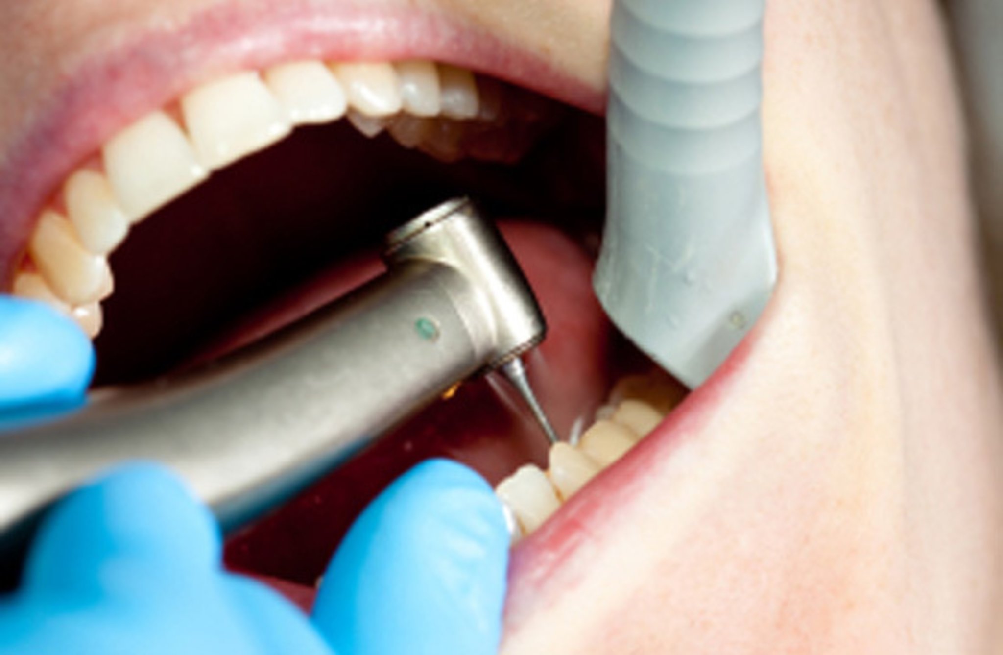 Die giftige Plombe in unserem Mund - Gladbeck