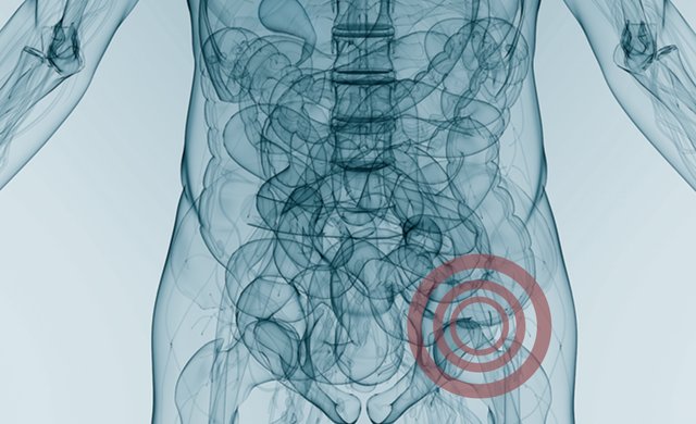 Leistenbruch - Harmlos oder ein Notfall?